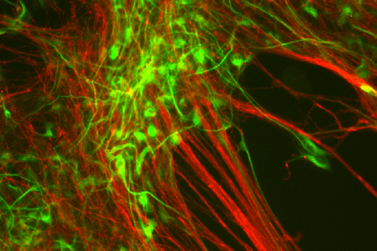 NEWS AND UPDATES – The STEM-PD Clinical Trial