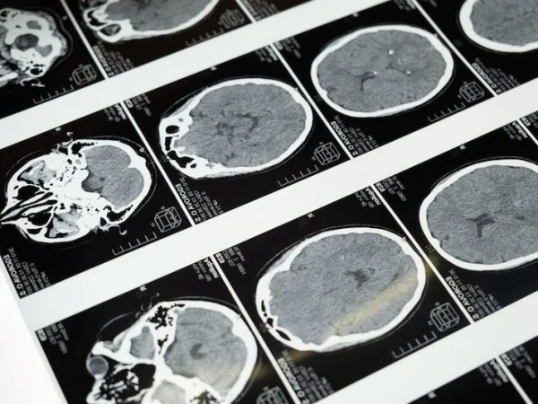 NEWS AND UPDATES – The STEM-PD Clinical Trial